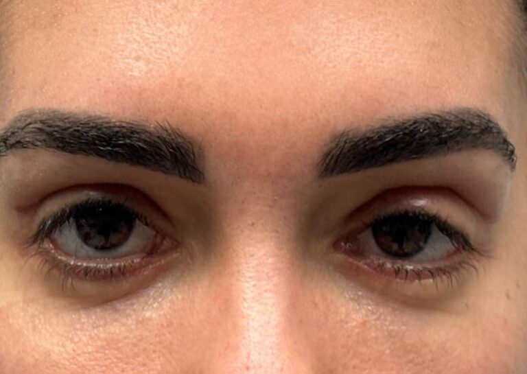 Scar Revision Before and After Photos | Dr. Gregory D. Lewen - Miami