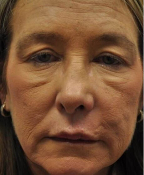 CO2 Laser Before and After Photos | Dr. Gregory D. Lewen - Miami