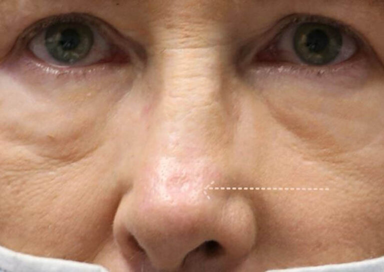 Scar Revision Before and After Photos | Dr. Gregory D. Lewen - Miami