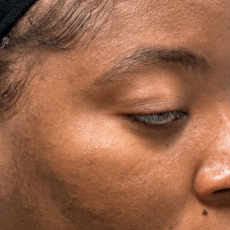 Ptosis Repair Before and After Photos | Dr. Gregory D. Lewen - Miami